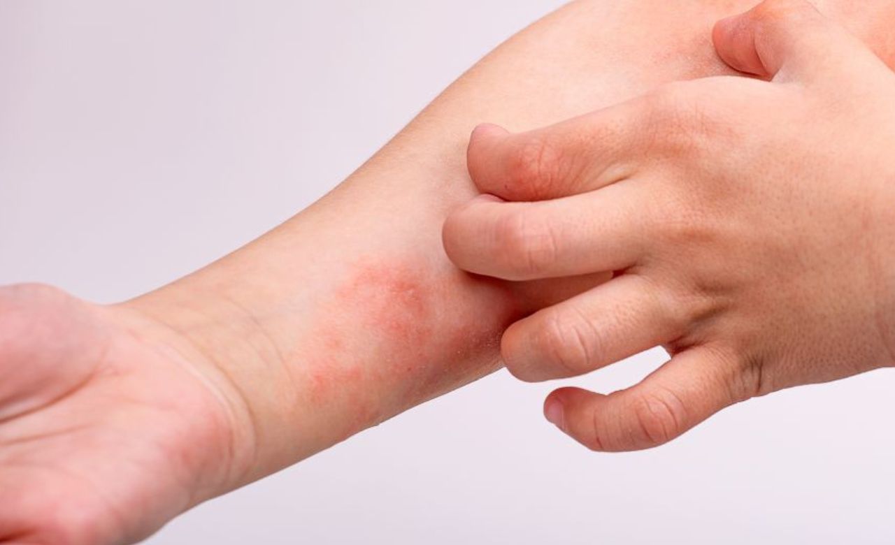Si Kecil Rewel Karena Gatal? Waspadai Dermatitis Atopik, Begini Gejala ...